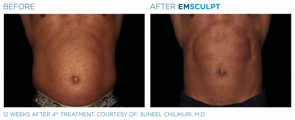 Sick of Back Pain? | Emsculpt in McLean Can Help | Ultra Body Sculpt