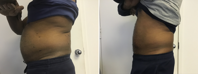 Male Waist - Elite Body Contouring in Northern Virginia | Ultra Body Sculpt