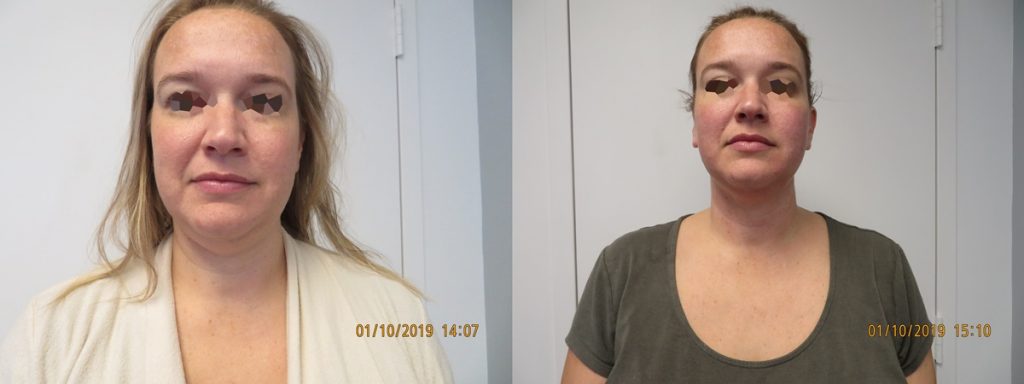 AMAZING RESULTS - Elite Body Contouring in Northern Virginia | Ultra ...