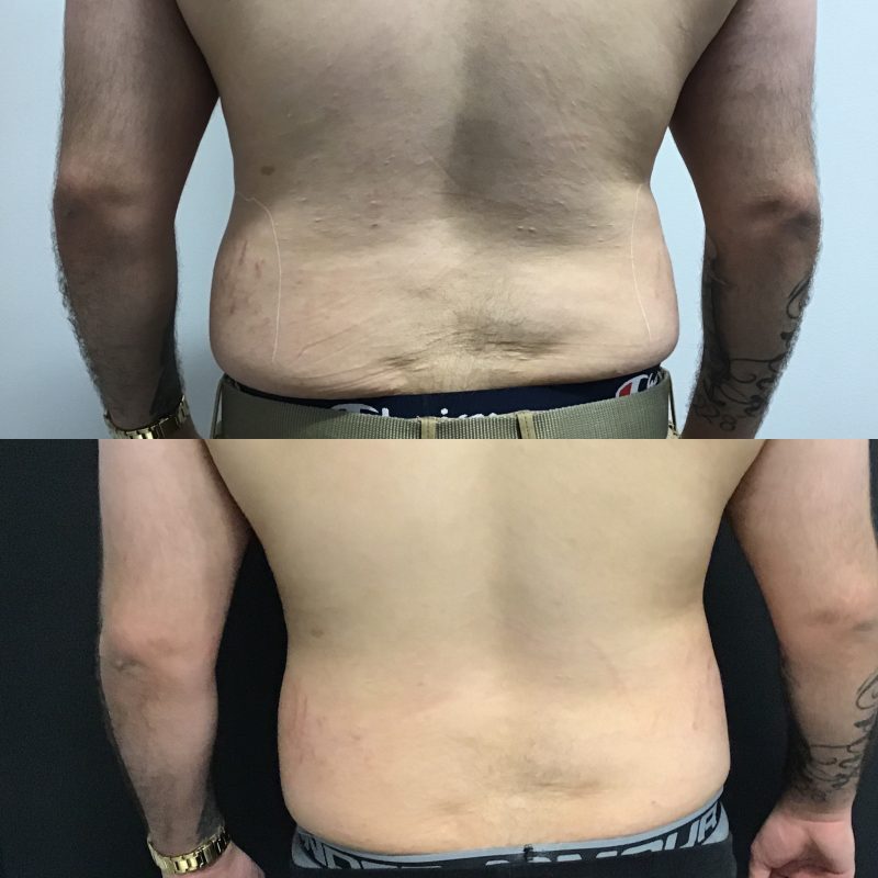 Male Lower Back - Elite Body Contouring in Northern Virginia | Ultra ...