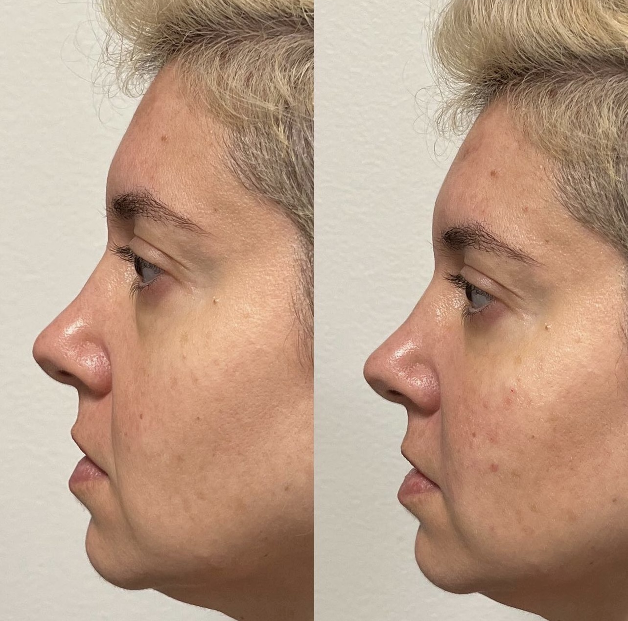 Anti-Aging - Elite Body Contouring in Northern Virginia | Ultra Body Sculpt
